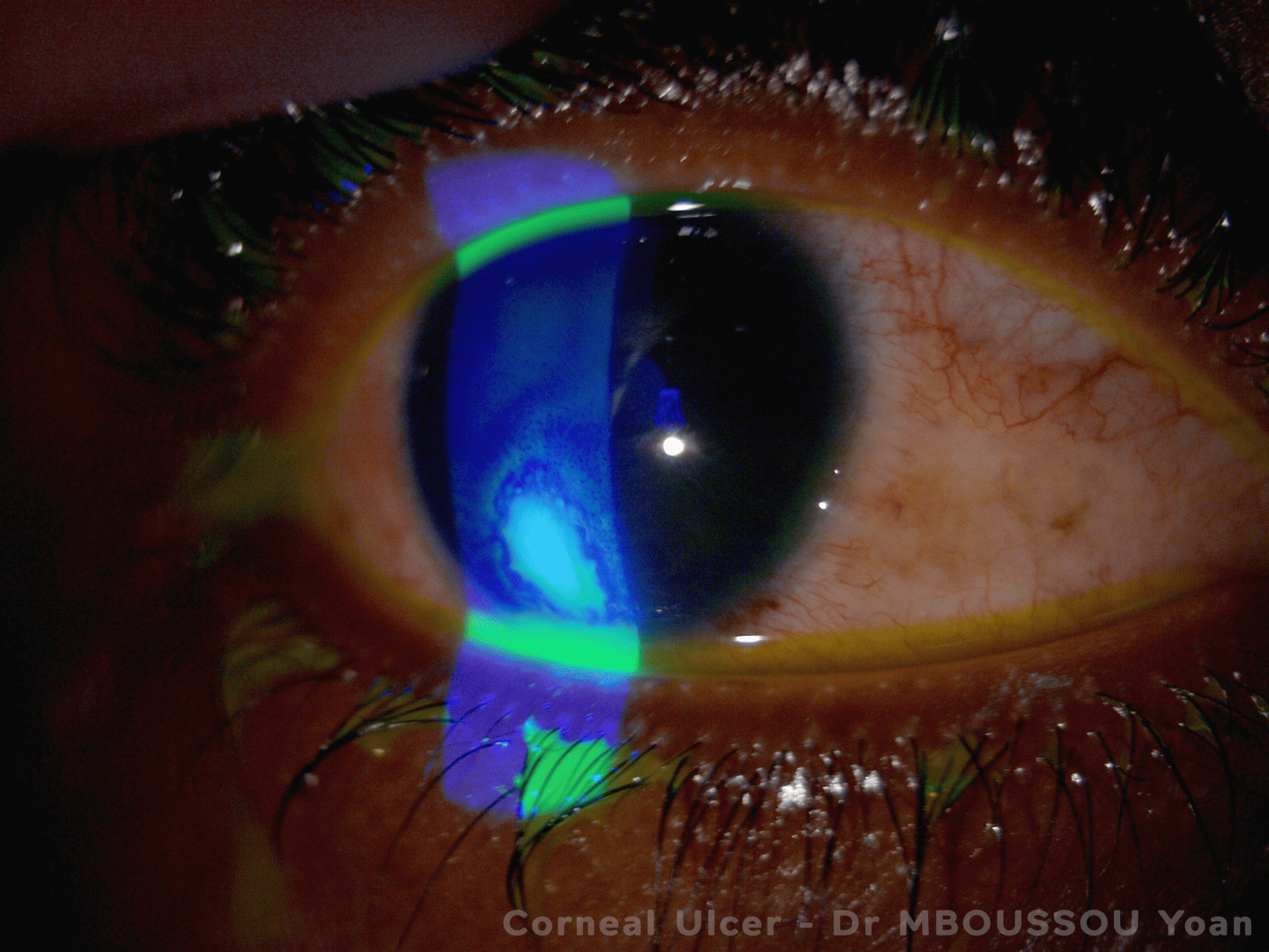 How Long After a Corneal Ulcer Can You Wear Contacts?