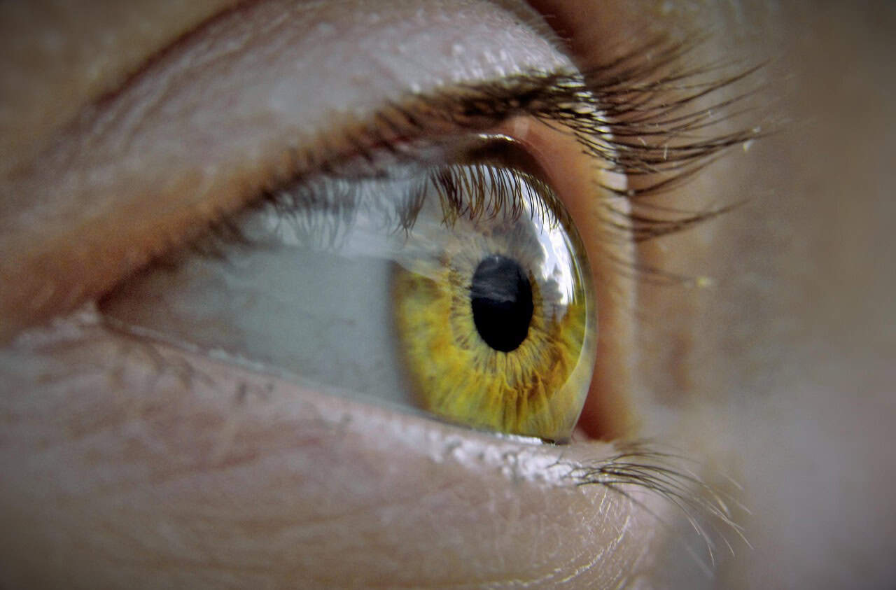 What Do Your Eyes Look Like in Graves Eye Disease Before and After ...